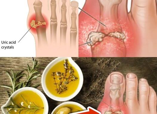 8 Easy Ways to Remove Excess Uric Acid: Naturally Beat the Painful ...