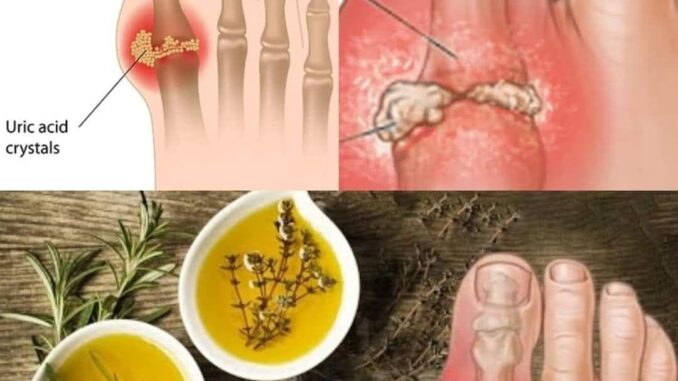 8 Easy Ways to Remove Excess Uric Acid (Easier Than You Think ...